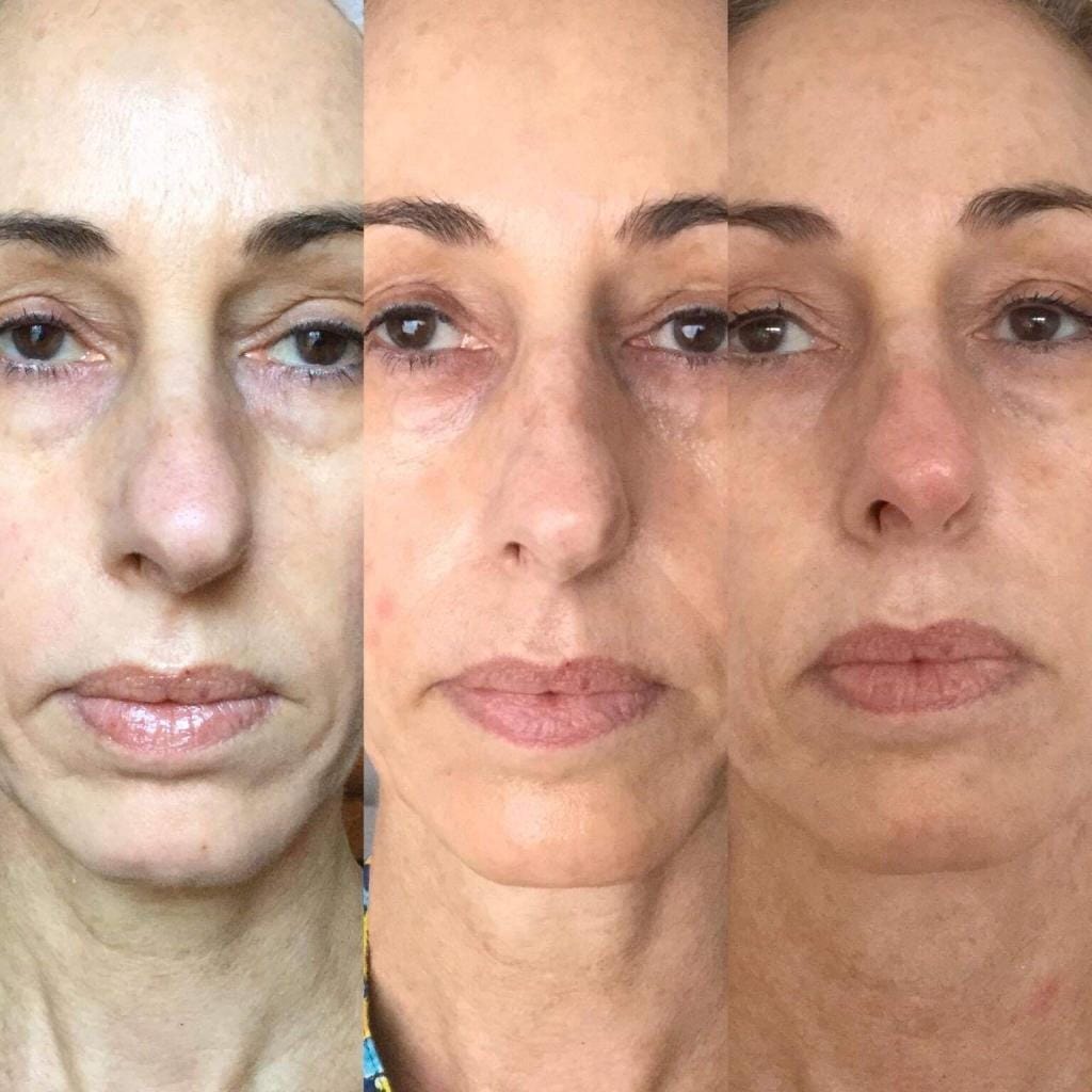 Plasma Lift Boulder, Colorado | Fibroblasty Skin Tightening ...