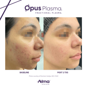 Opus Plasma Laser Treatment in Boulder, Colorado ~ The Beauty Spot ...