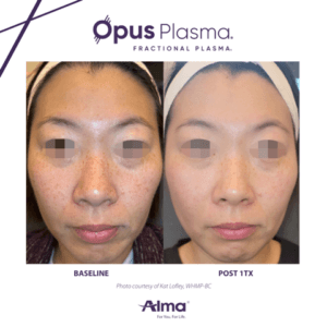 Opus Plasma Laser Treatment in Boulder, Colorado ~ The Beauty Spot ...