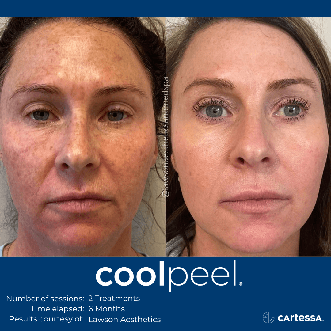 Cool Peel Before After Gallery Boulder Colorado The Beauty Spot Cool Peel Before After Gallery Boulder Colorado The Beauty Spot